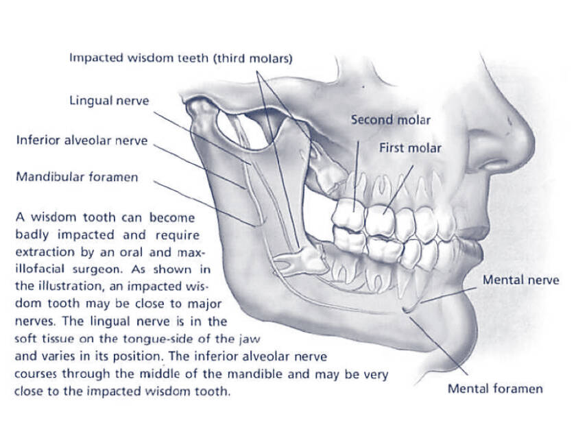 Wisdom Tooth - OMS Specialists