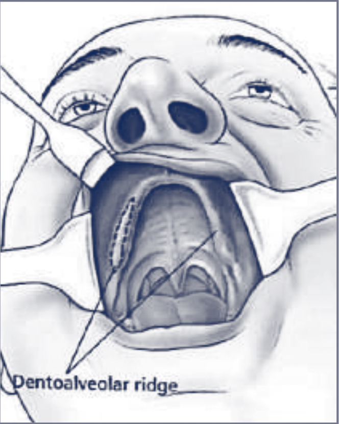 Dento-Alveolar Surgery - OMS Specialists