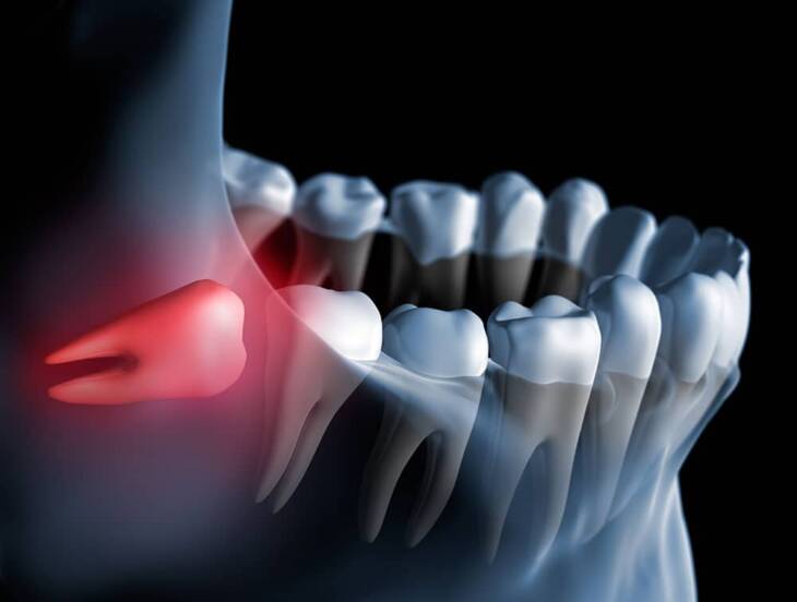 Wisdom Tooth - OMS Specialists